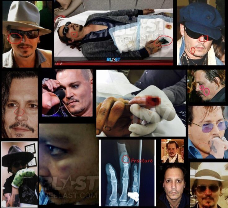 Johnny Depp Testifies About Ex-Wife Amber Heard Cutting The Tip of His ...